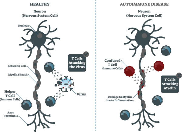 Antioxidant Supplements for Autoimmune Disease - 4 What Ails U
